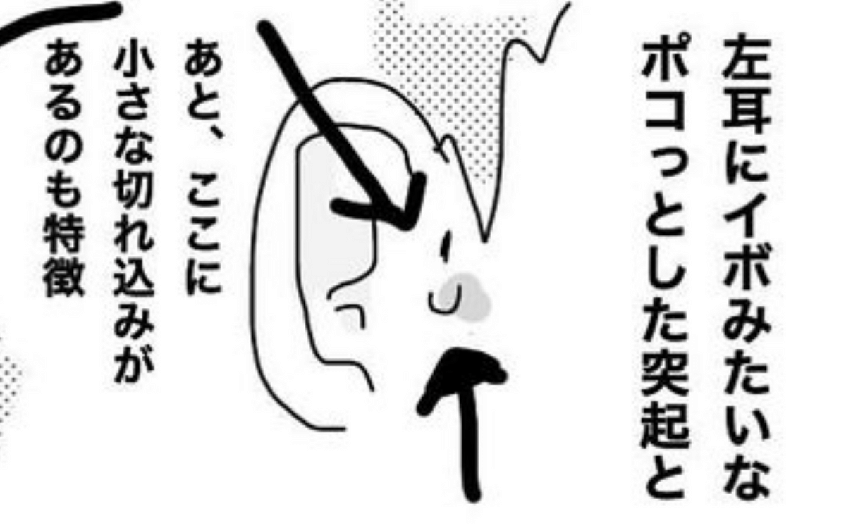 1000人に15人がなる『副耳』を持って生まれた息子→切除を迷うも…母がとった“決断”に称賛の声 | TRILL【トリル】