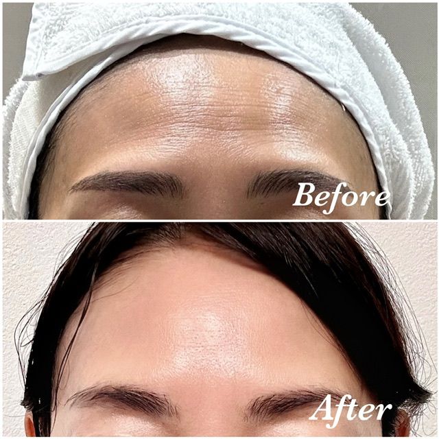 ソウル最新美容医療レポ！気になる顔の上半分の加齢悩みを一気に解決【おでこのしわetc.】 | TRILL【トリル】