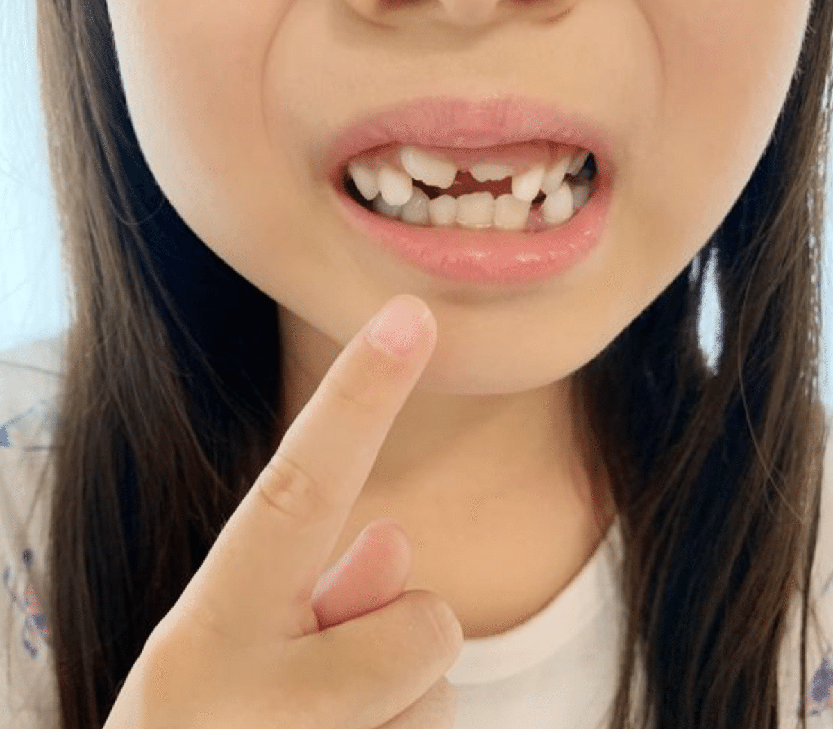 『すきっ歯』矯正には120万円かかる！？ 年間7,300時間の装着が必要な治療のウラ側、歯科医が語る“驚きのデメリット”とは？ | TRILL【トリル】